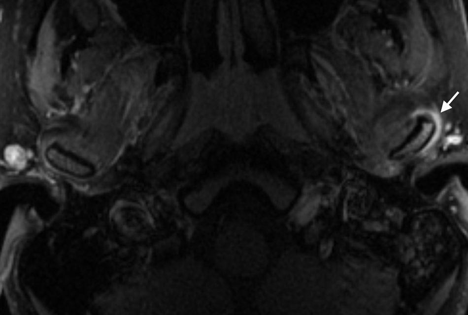La articulación temporomandibular en la artritis idiopática juvenil: lo ...