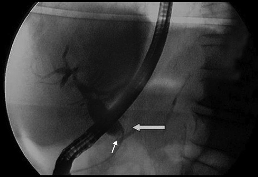 Litiasis y estenosis del colédoco provocada por la migración de un clip ...