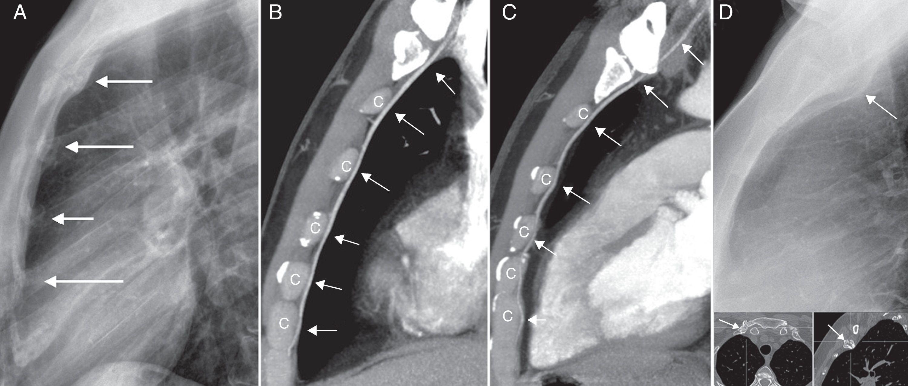 Radiografía lateral de tórax. Anatomía radiográfica | Radiología