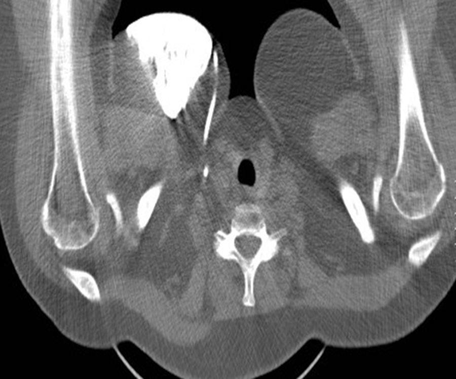 Administración de contrastes intravenosos: las extravasaciones | Radiología