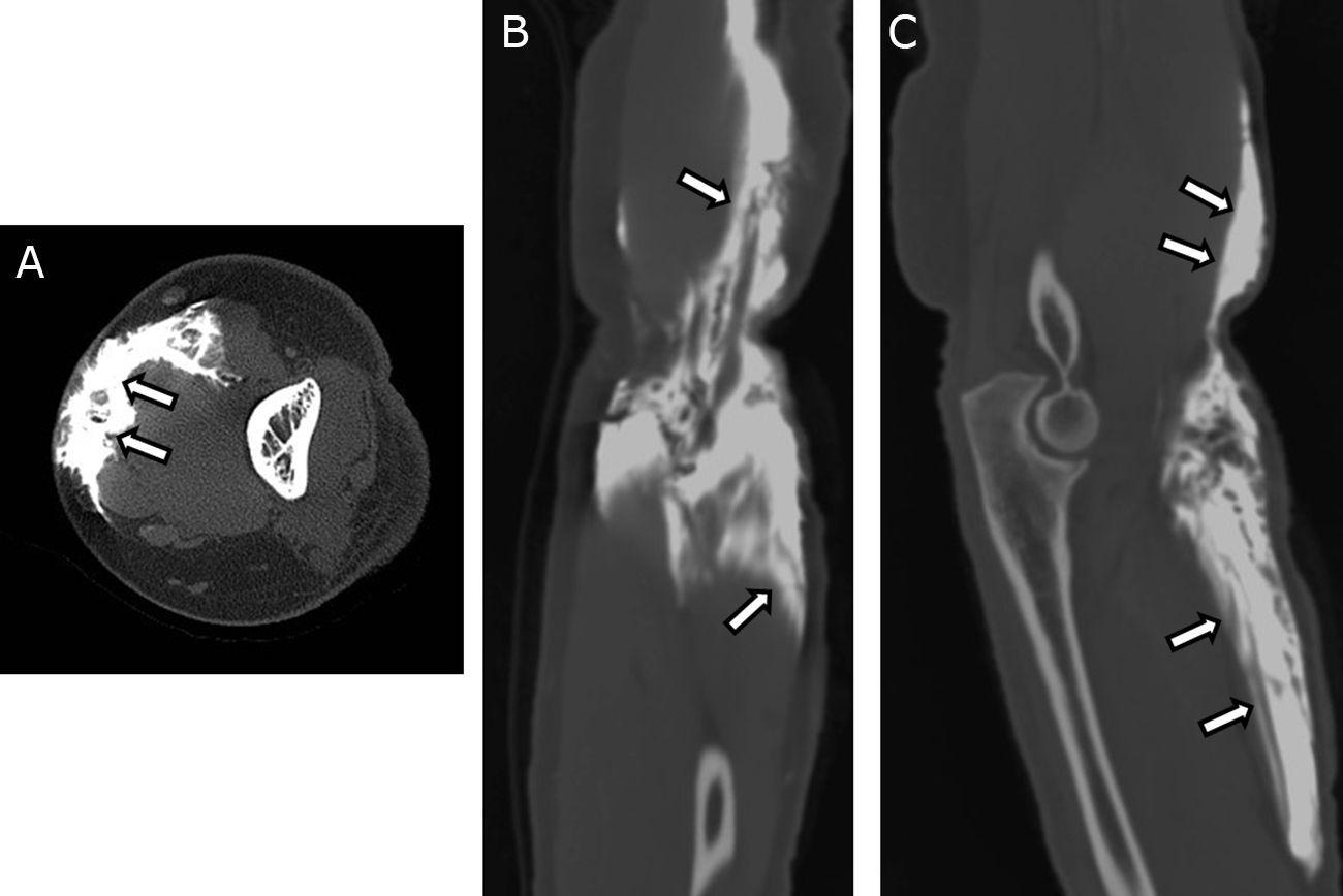 Administración de contrastes intravenosos: las extravasaciones | Radiología