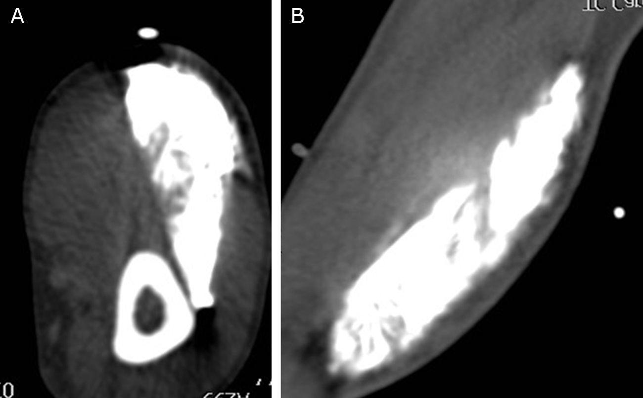 Administración de contrastes intravenosos: las extravasaciones | Radiología