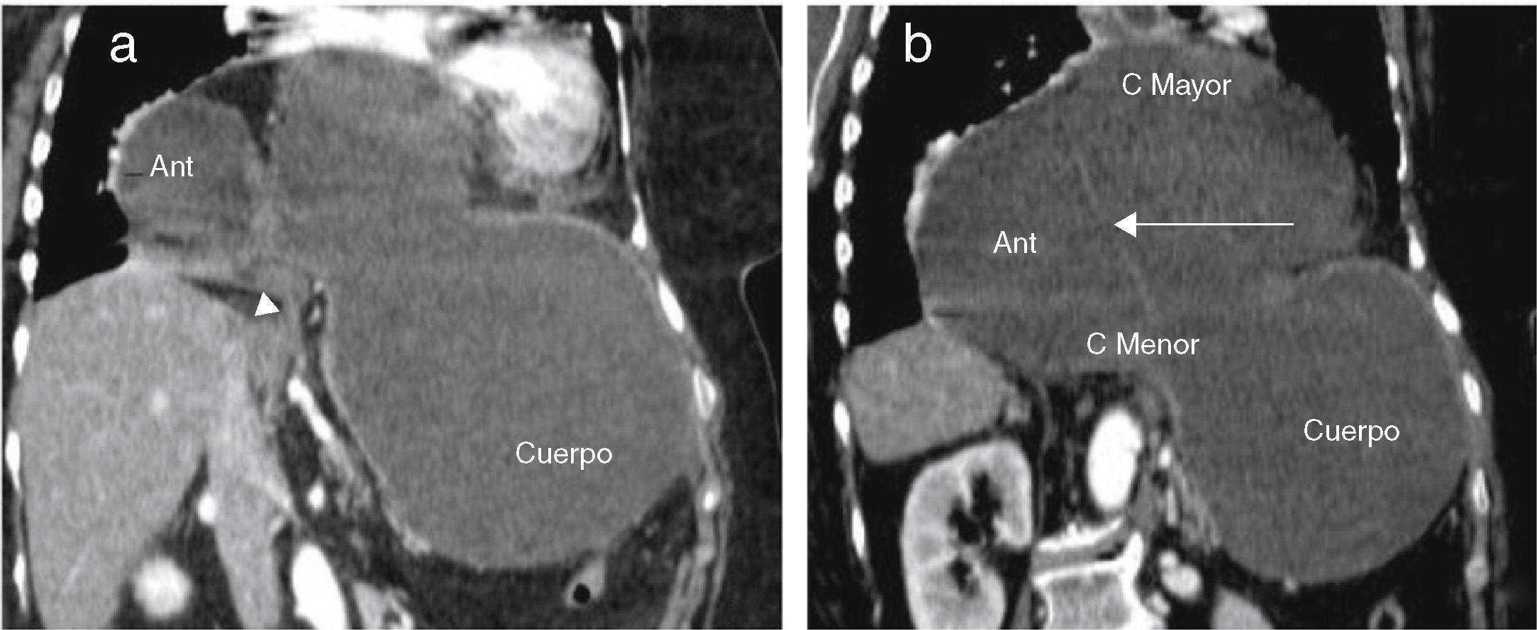 Vólvulos del tracto gastrointestinal. Diagnóstico y correlación entre ...