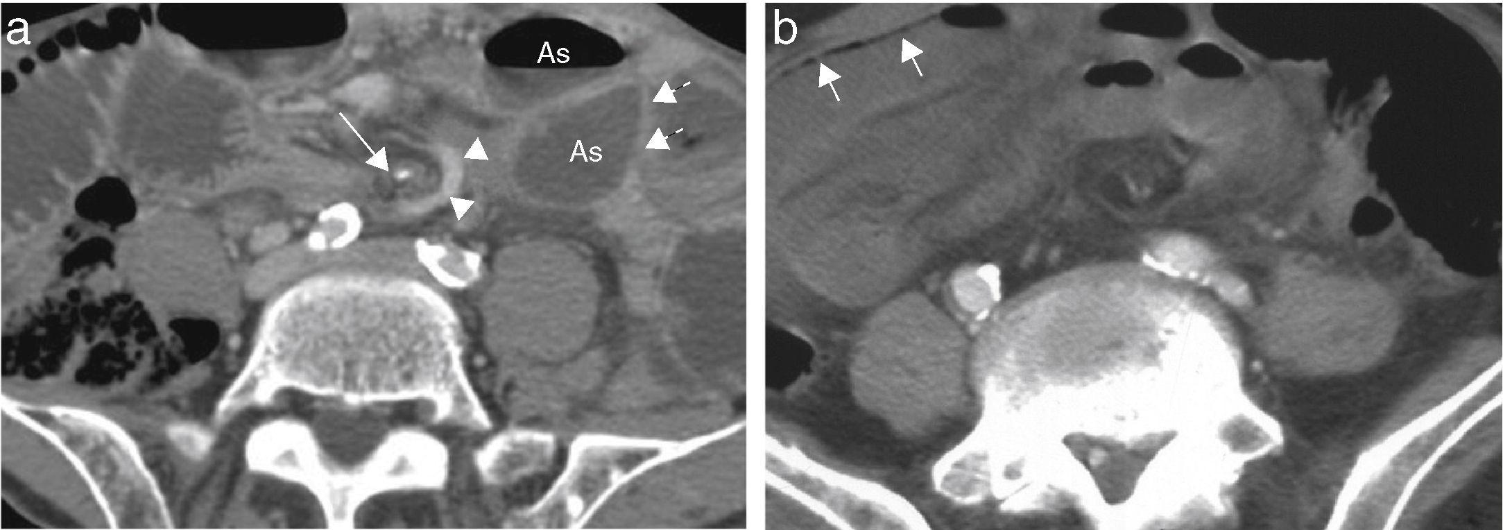 Vólvulos del tracto gastrointestinal. Diagnóstico y correlación entre ...