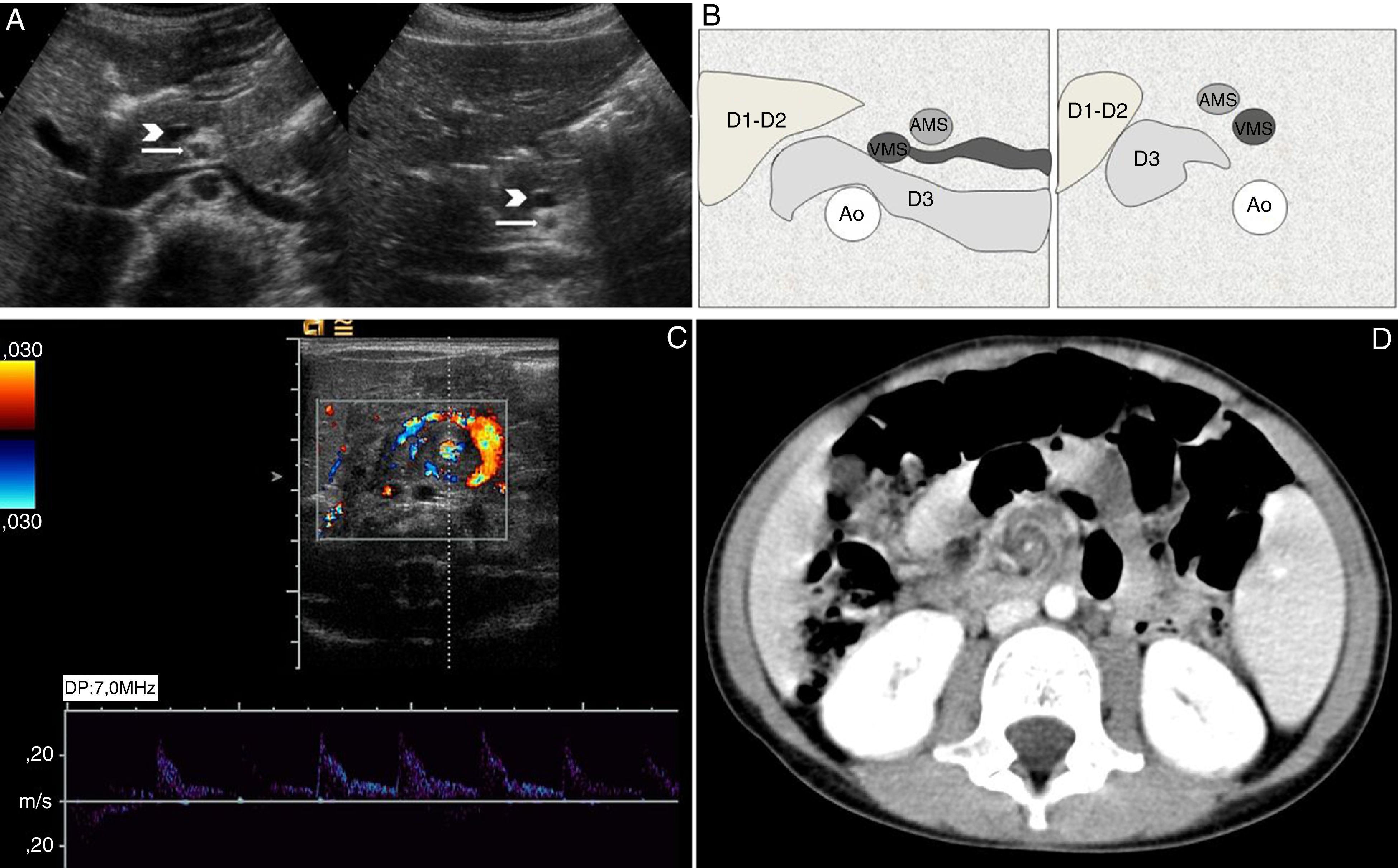 Malrotación-vólvulo intestinal: hallazgos radiológicos | Radiología