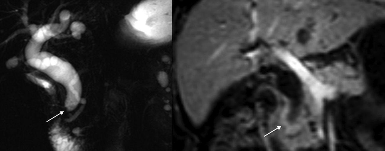 Tumores de la vía biliar | Radiología