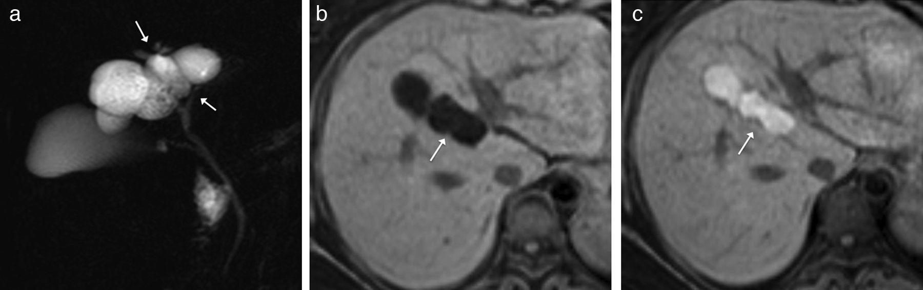 Tumores de la vía biliar | Radiología