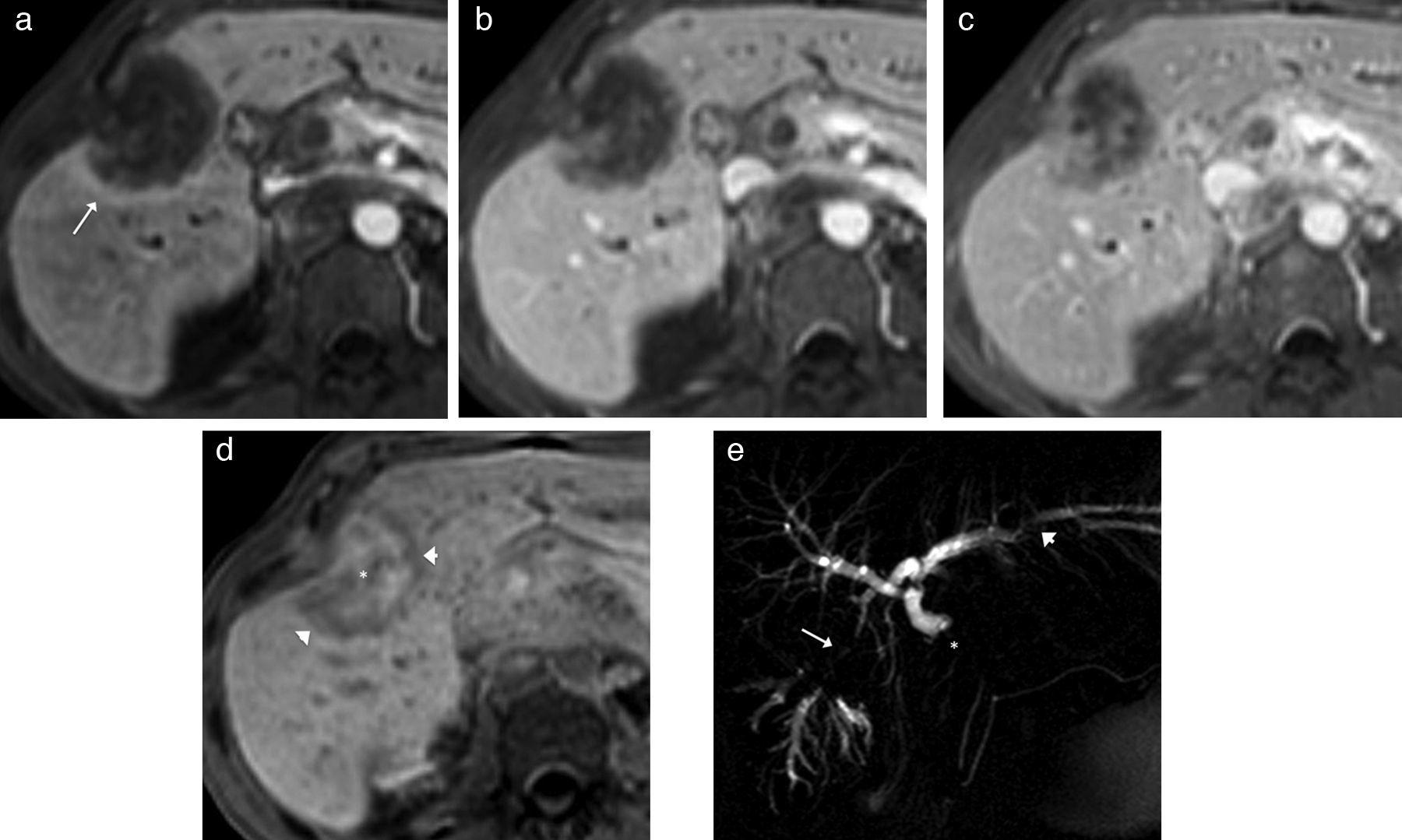 Tumores de la vía biliar | Radiología