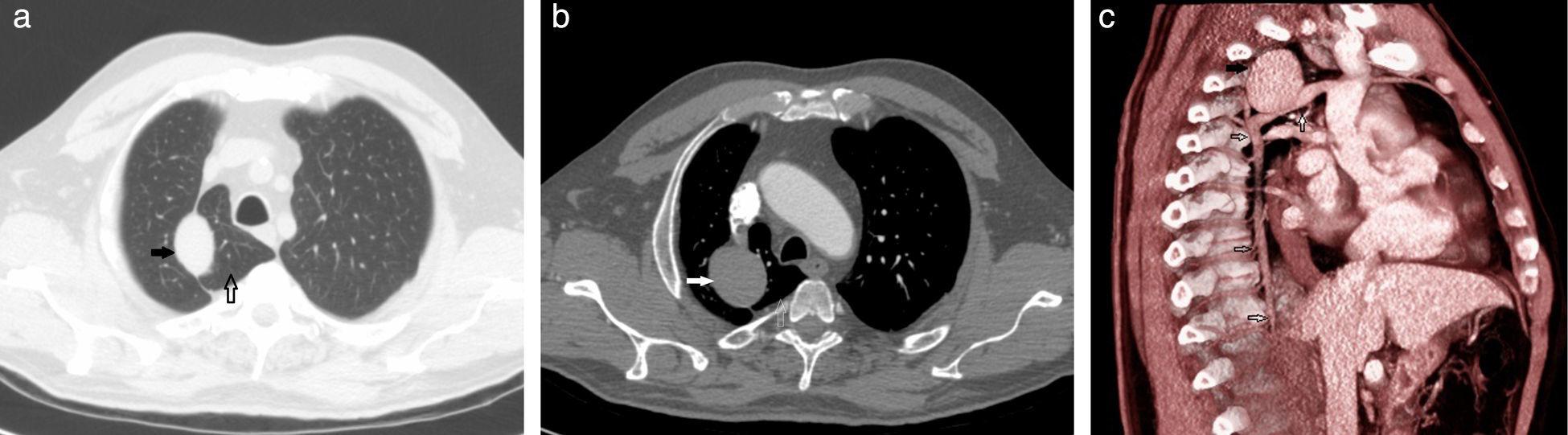 Aneurisma sacular de la vena ácigos en un paciente con cisura accesoria ...