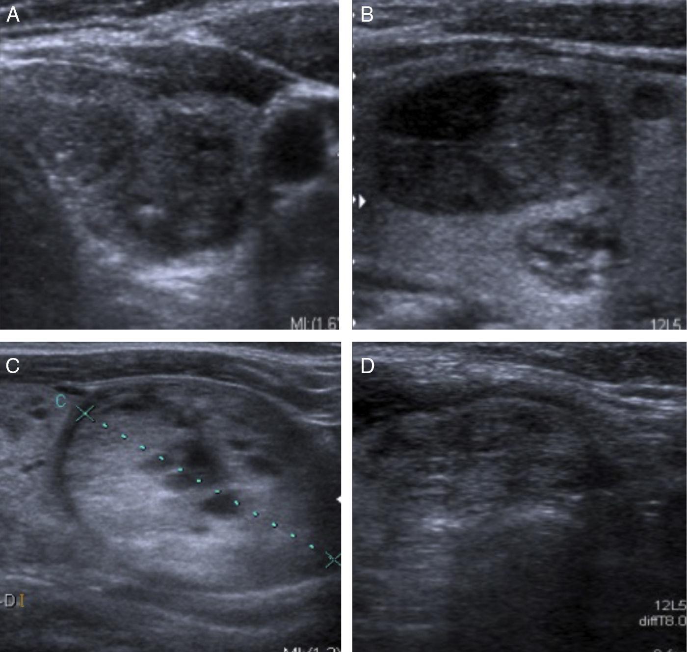 Valor actual de la ecografía en la caracterización de los nódulos ...