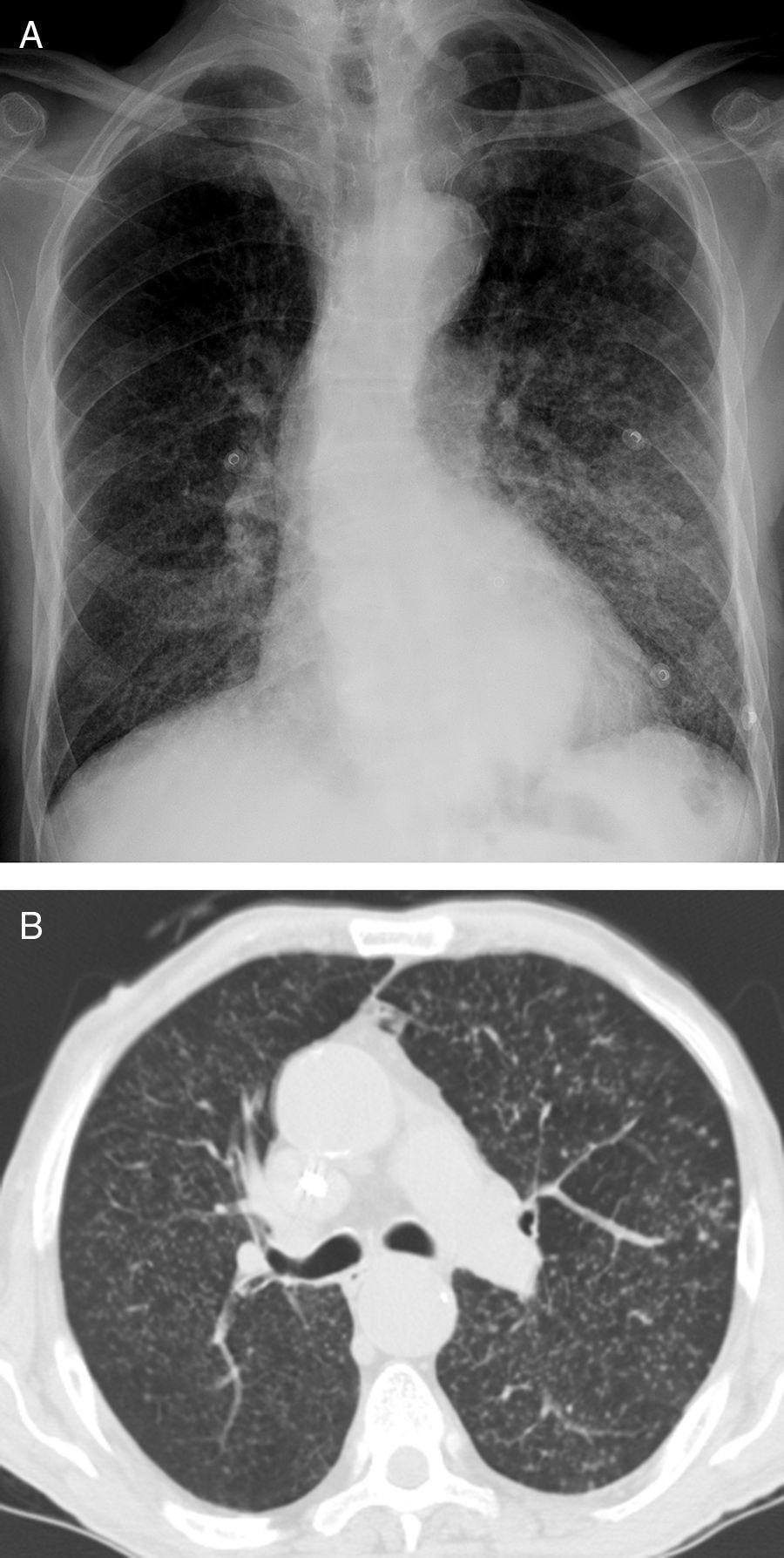 Puesta al día en el estudio radiológico de la tuberculosis pulmonar ...