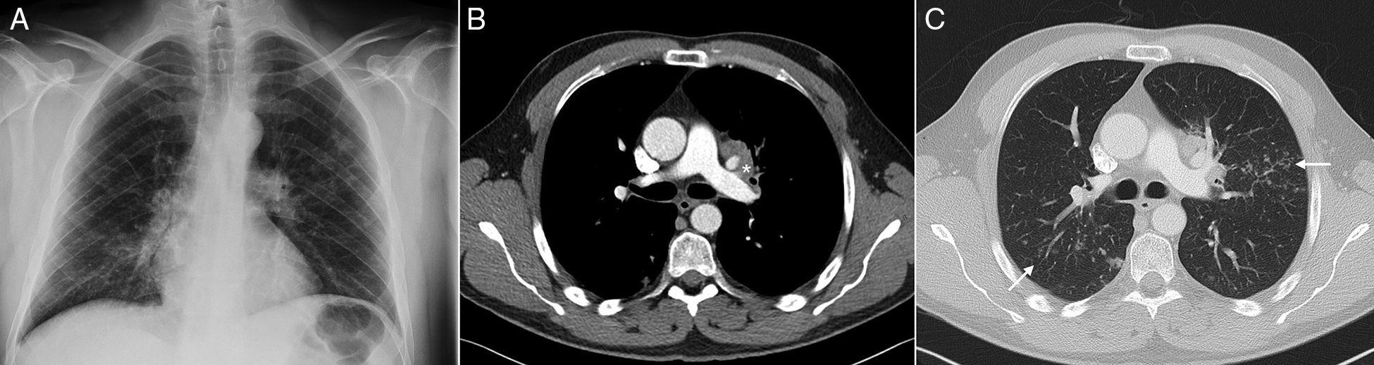 Tularemia pulmonar | Radiología