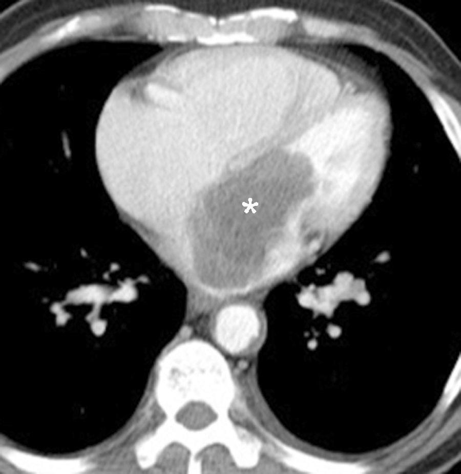 Hallazgos de imagen de las masas cardíacas (parte I): protocolo de ...