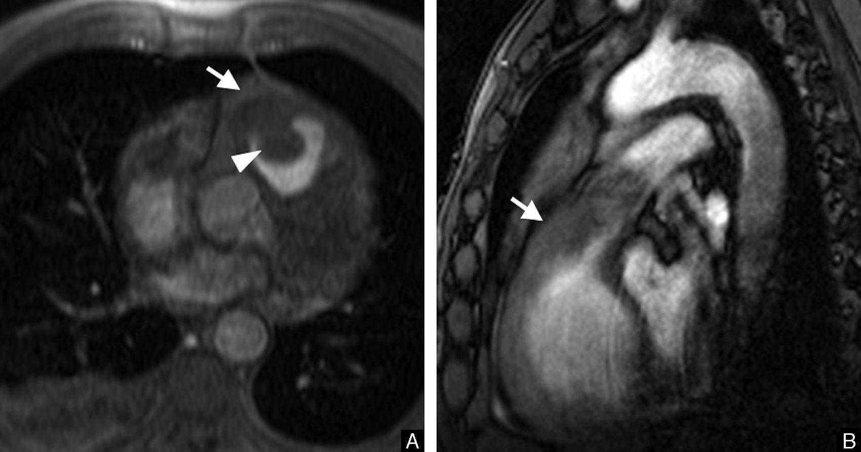 Hallazgos de imagen de las masas cardíacas (parte II): tumores malignos ...