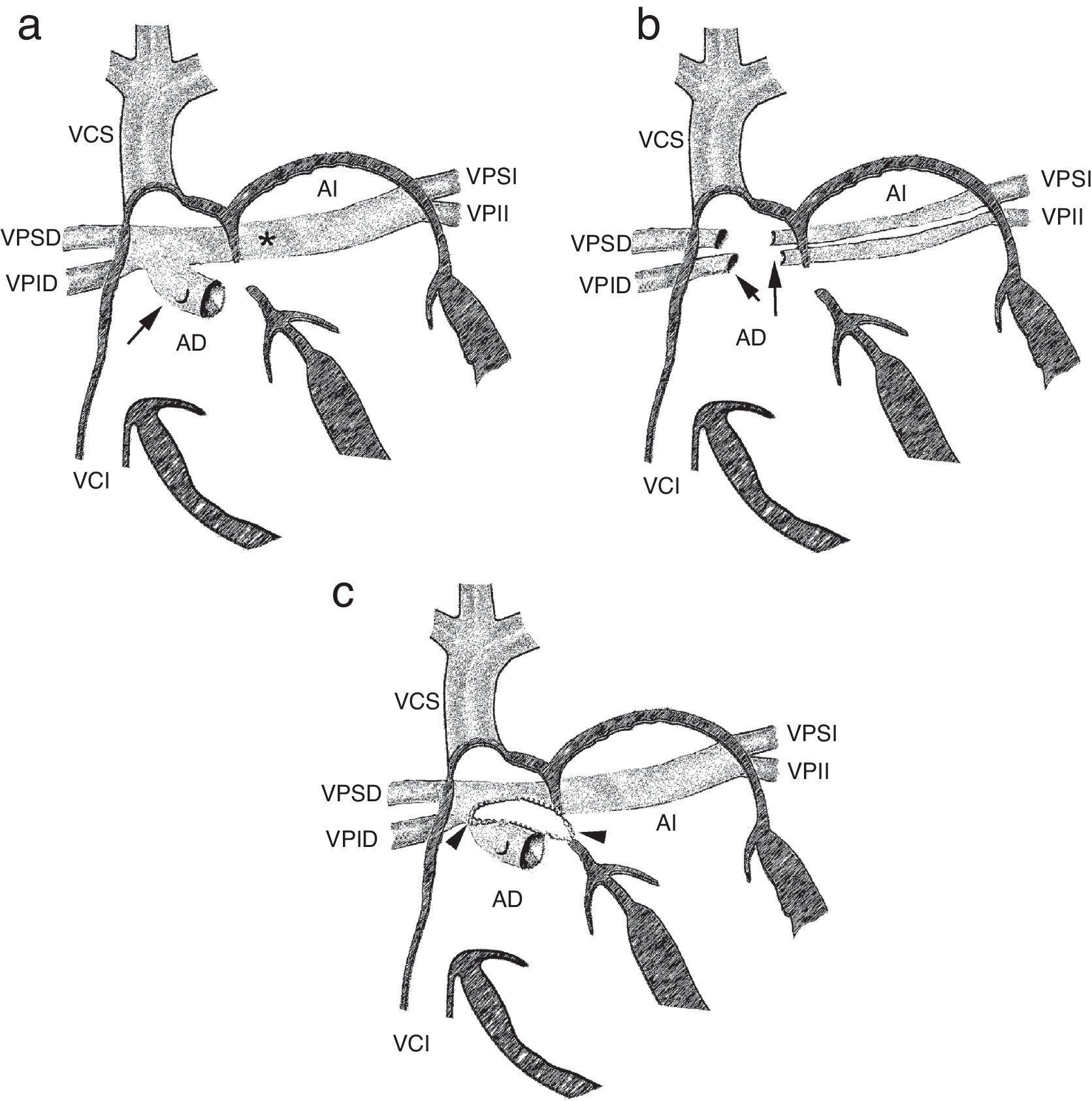 Resonancia magnética en la valoración de las conexiones venosas ...