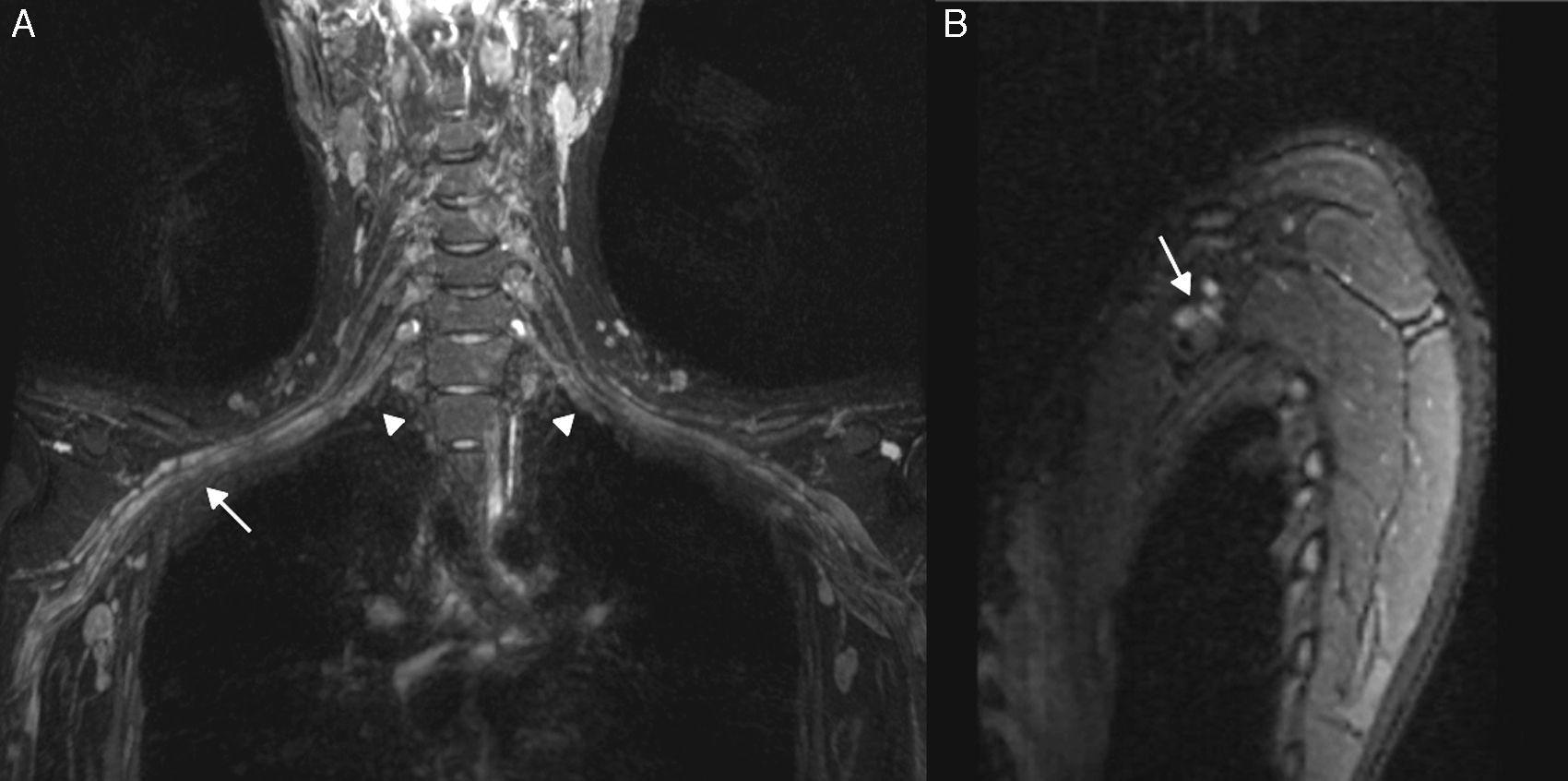 Neurografía de alta resolución en resonancia magnética 3 Tesla del ...