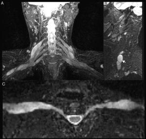 Neurografía de alta resolución en resonancia magnética 3 Tesla del ...