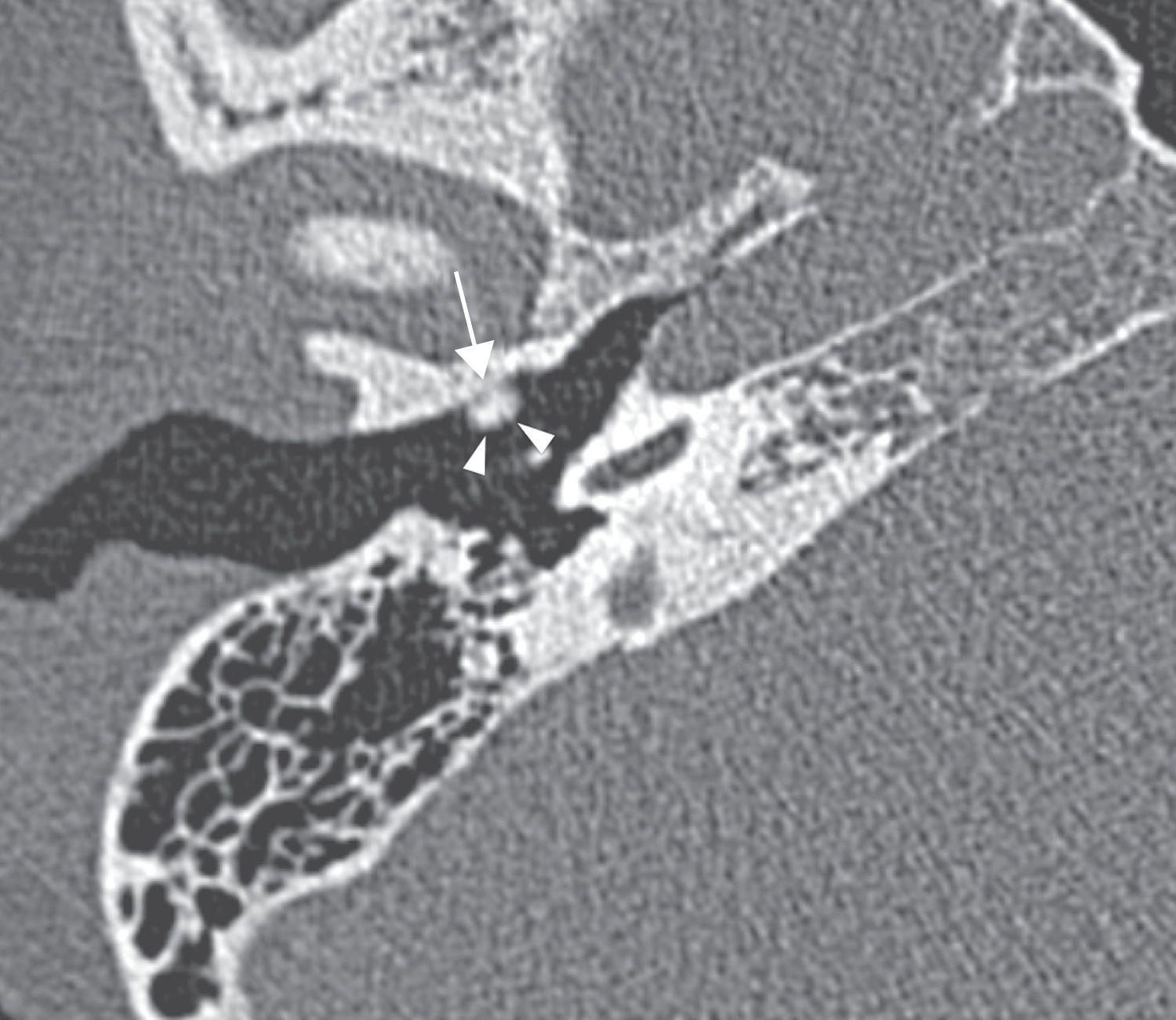 Radiología del oído externo: indicaciones, anatomía normal y procesos ...