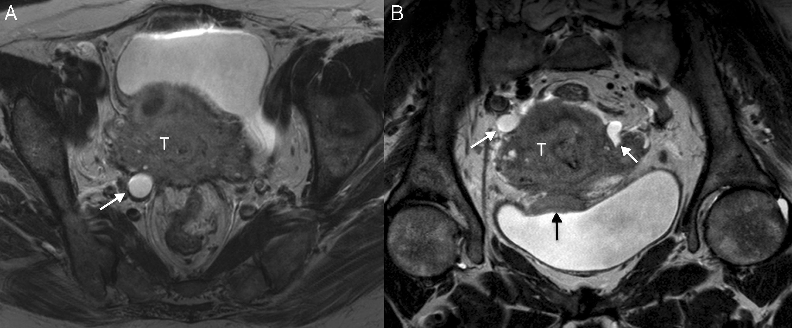 Imagen por resonancia magnética en la estadificación y planificación ...