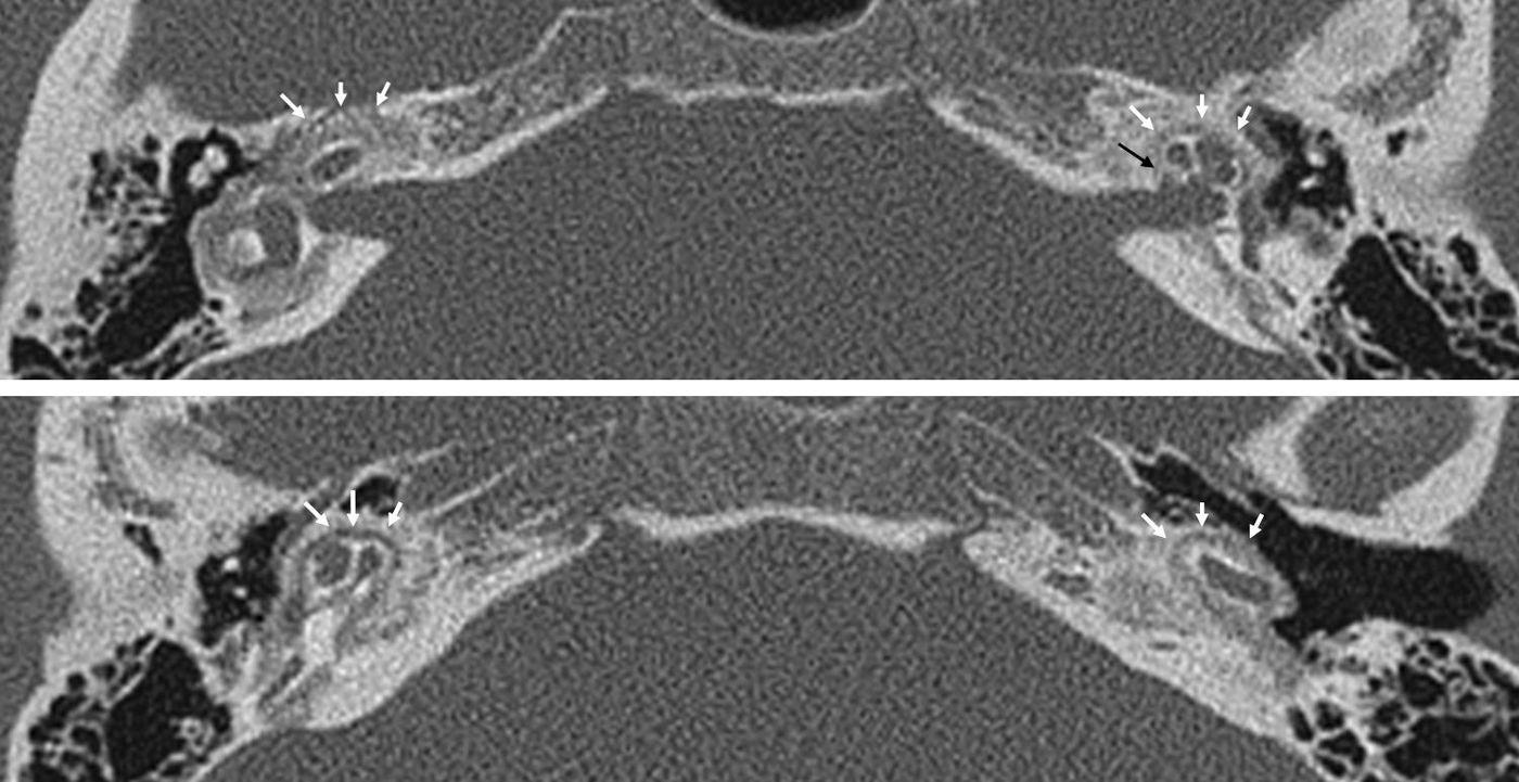 Actualización en el diagnóstico radiológico de la otosclerosis | Radiología