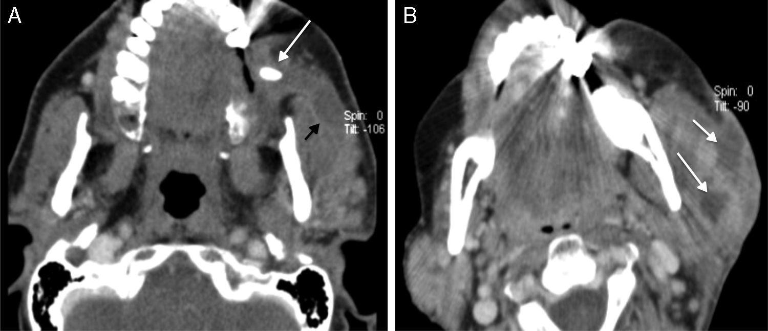 Urgencias no traumáticas de cabeza y cuello. Aproximación desde la ...