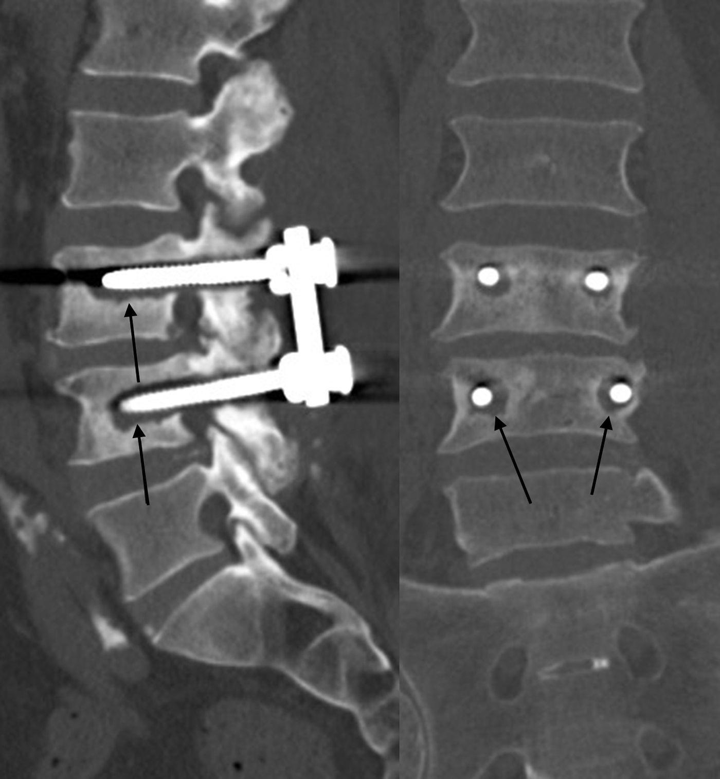 La columna poscirugía | Radiología