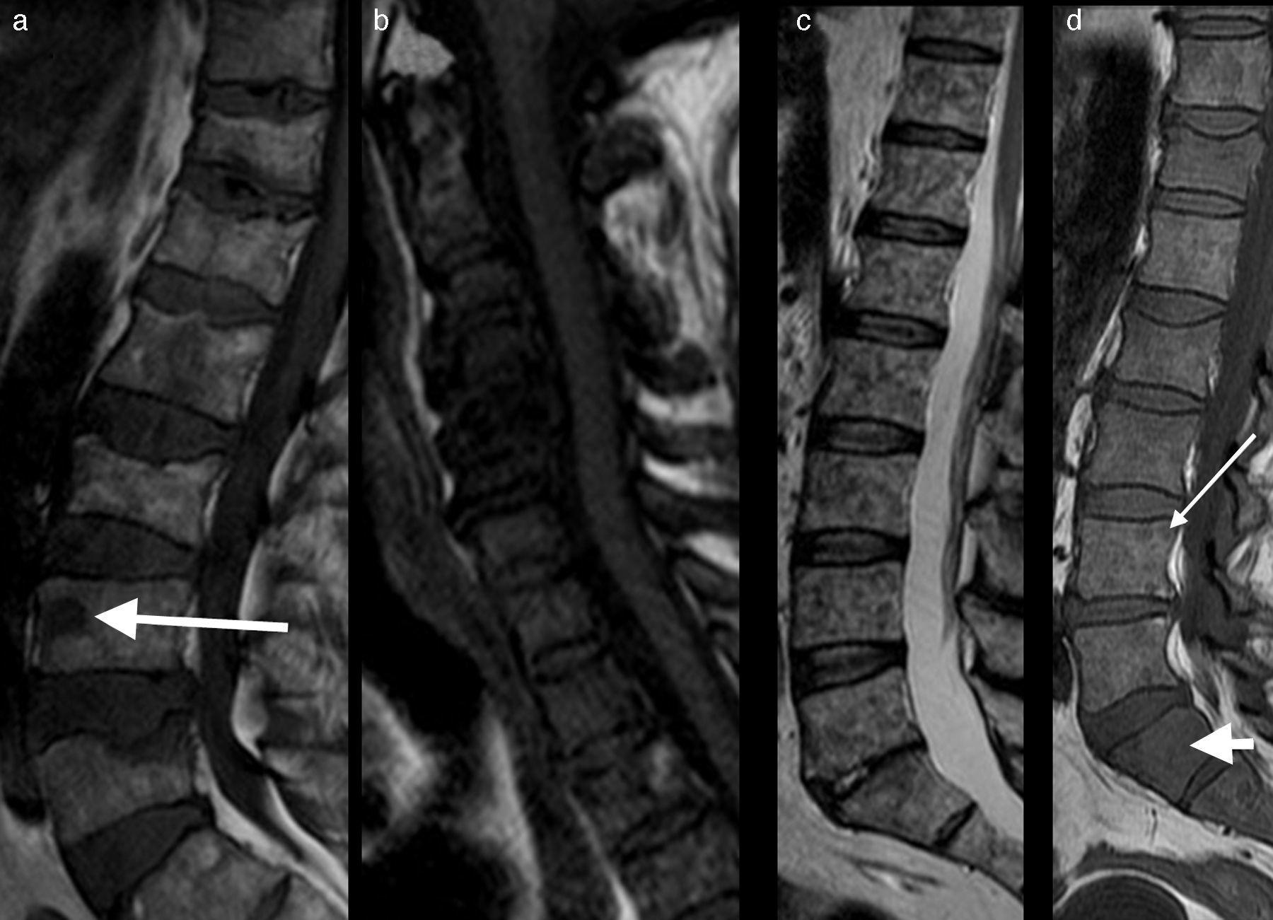 Infiltración de la médula ósea, mieloma múltiple y enfermedad ...
