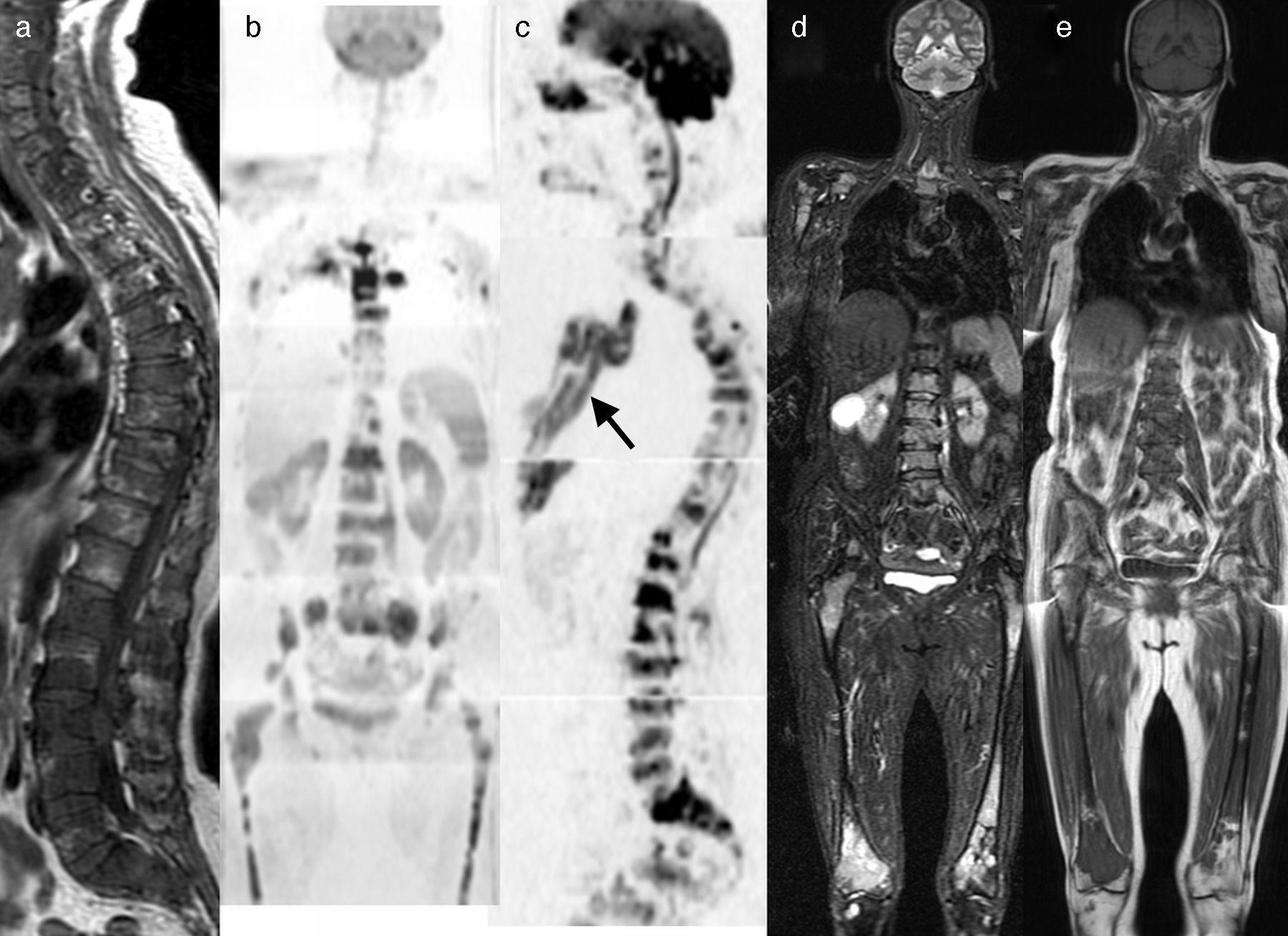 Infiltración de la médula ósea, mieloma múltiple y enfermedad ...