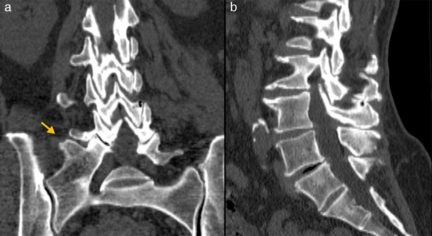 Errores diagnósticos en la columna | Radiología