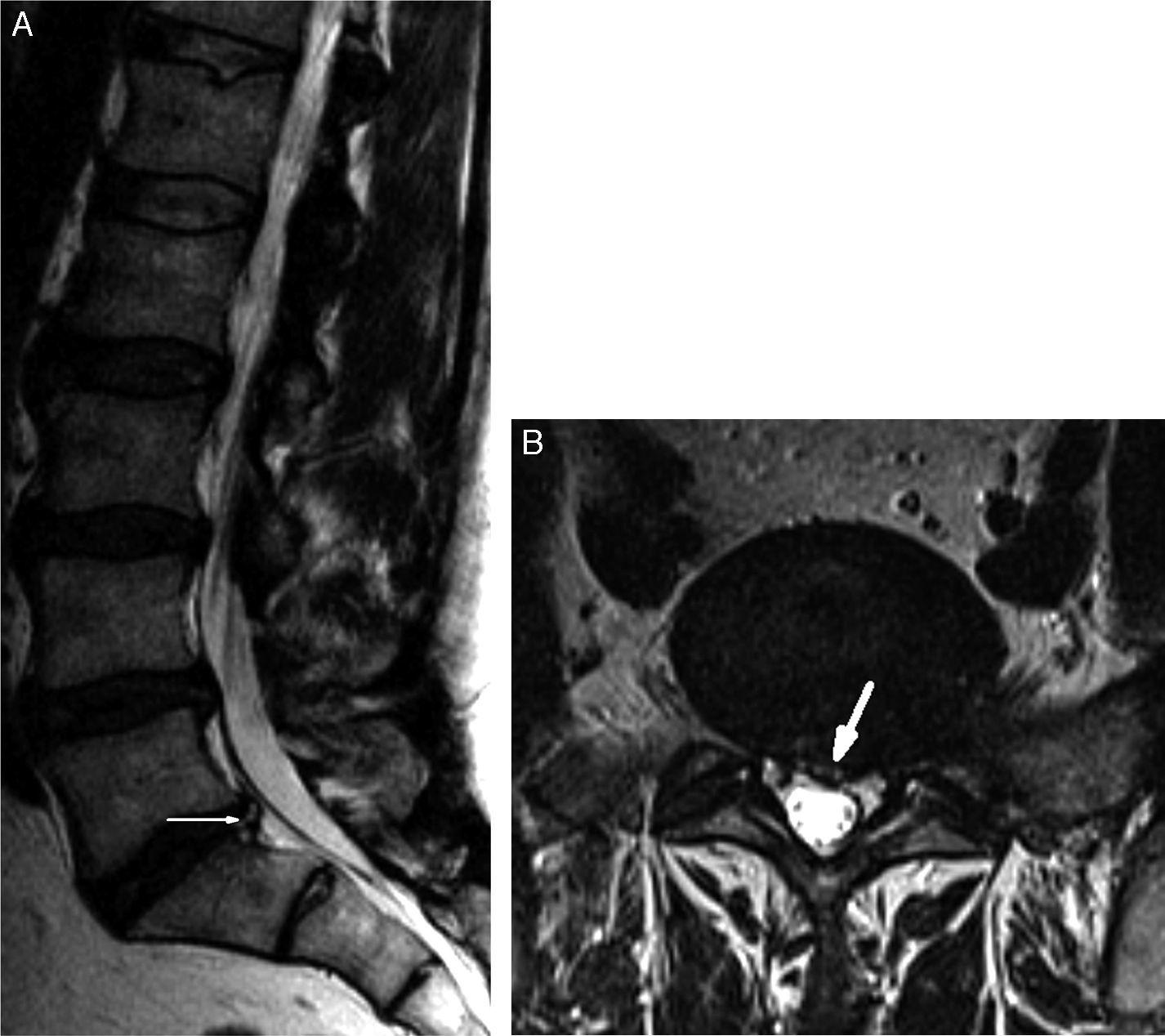 Patología degenerativa en la columna lumbar | Radiología
