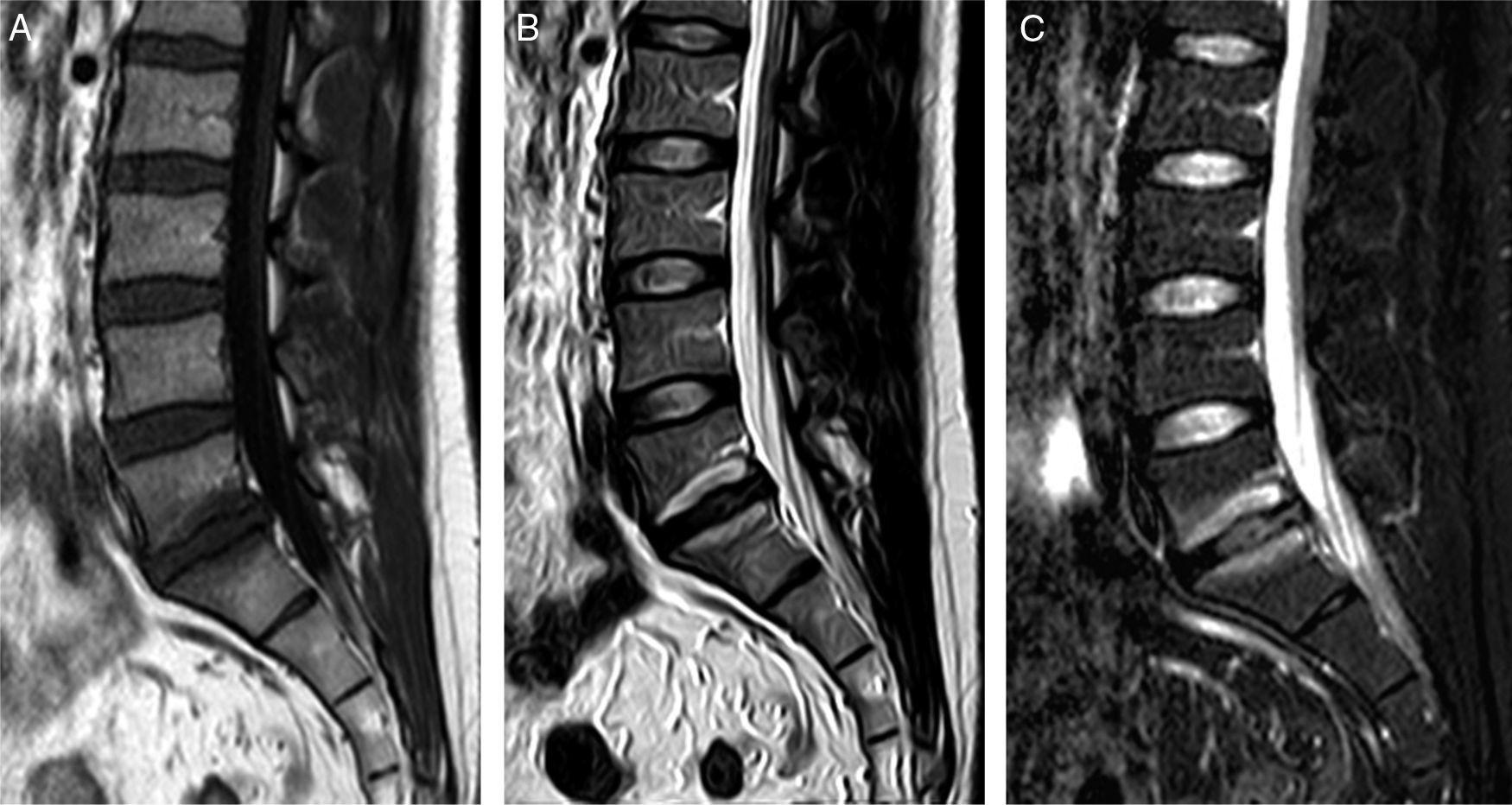 Espondilodiscitis | Radiología