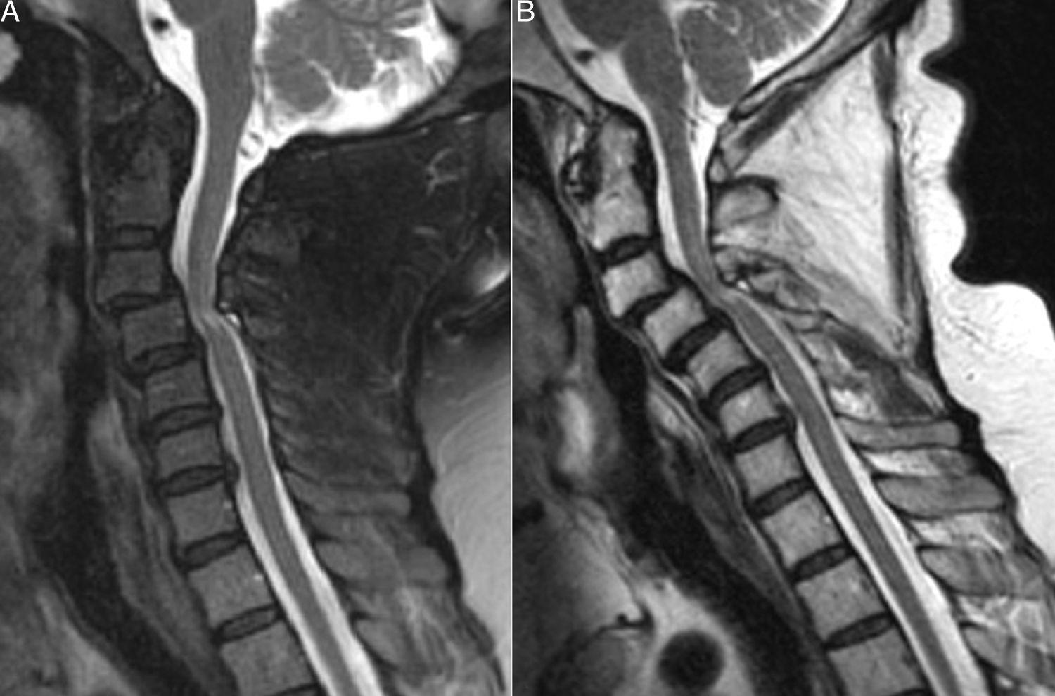 Enfermedades reumatológicas en la columna vertebral: diagnóstico ...