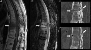 Enfermedades reumatológicas en la columna vertebral: diagnóstico ...