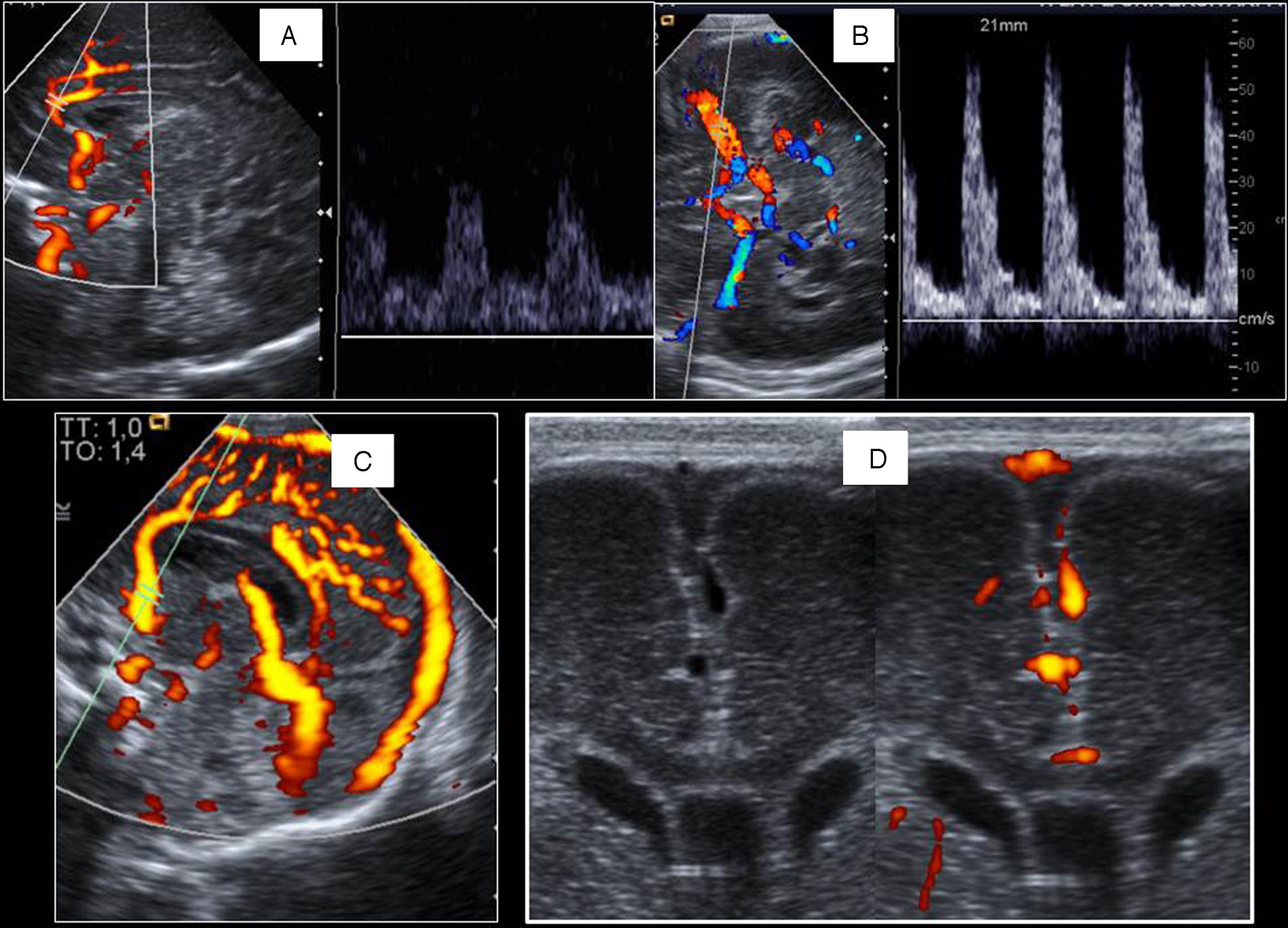 El ABC de la ecografía transfontanelar y más | Radiología