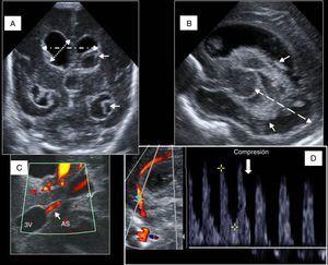 El ABC de la ecografía transfontanelar y más | Radiología