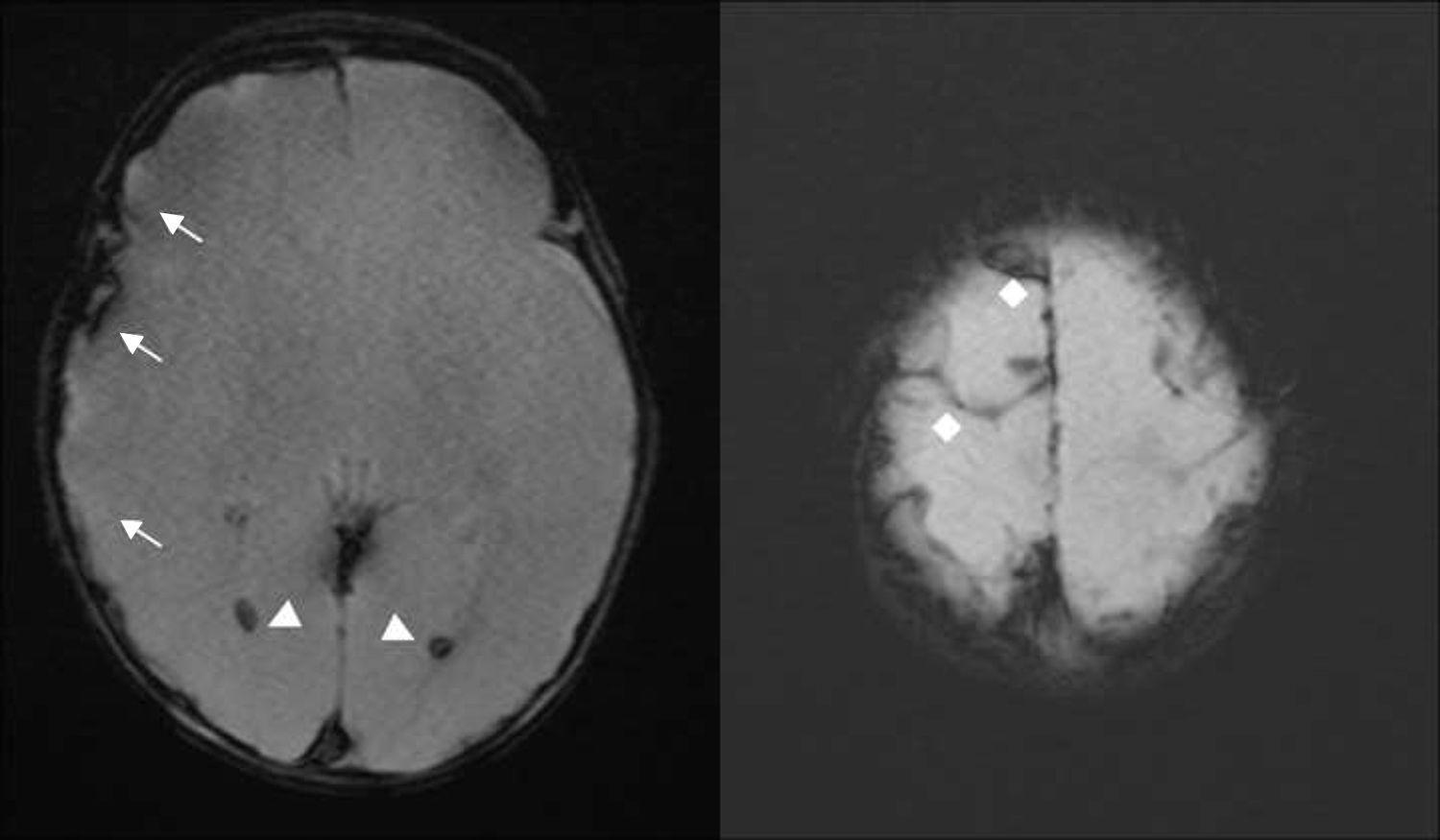 El papel del radiólogo ante el niño maltratado. Protocolo de imagen y ...