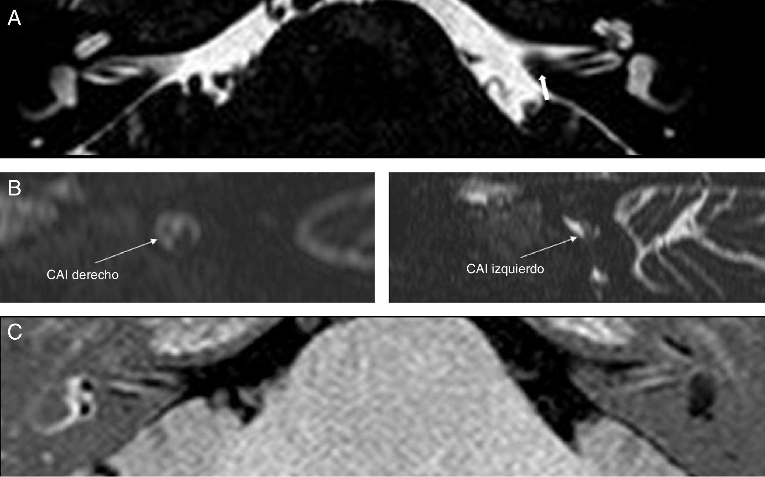 Diagnóstico del hidrops endolinfático mediante resonancia magnética de ...
