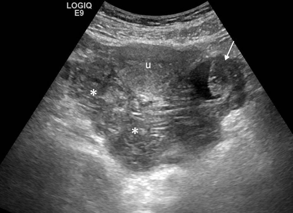 Dolor pélvico de origen ginecológico como patología urgente | Radiología
