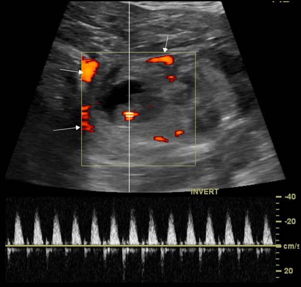Dolor pélvico de origen ginecológico como patología urgente | Radiología