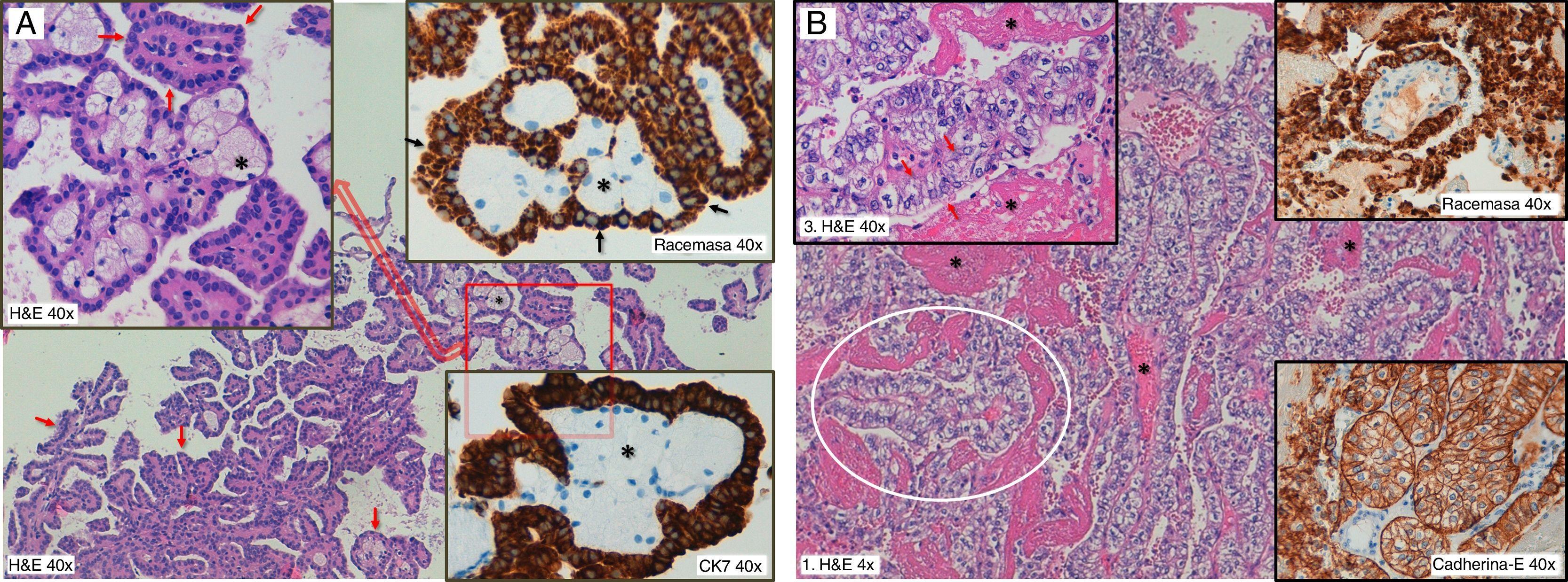 Carcinoma papilar de células renales: el papel del radiólogo en su ...
