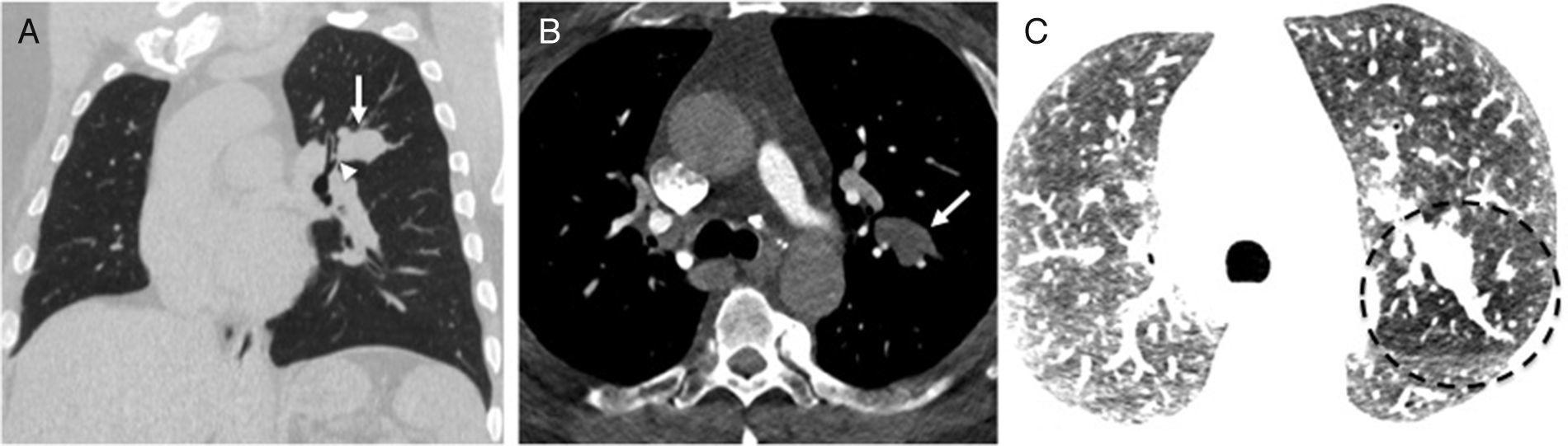 Papel de los estudios de imagen en el diagnóstico etiológico de las ...