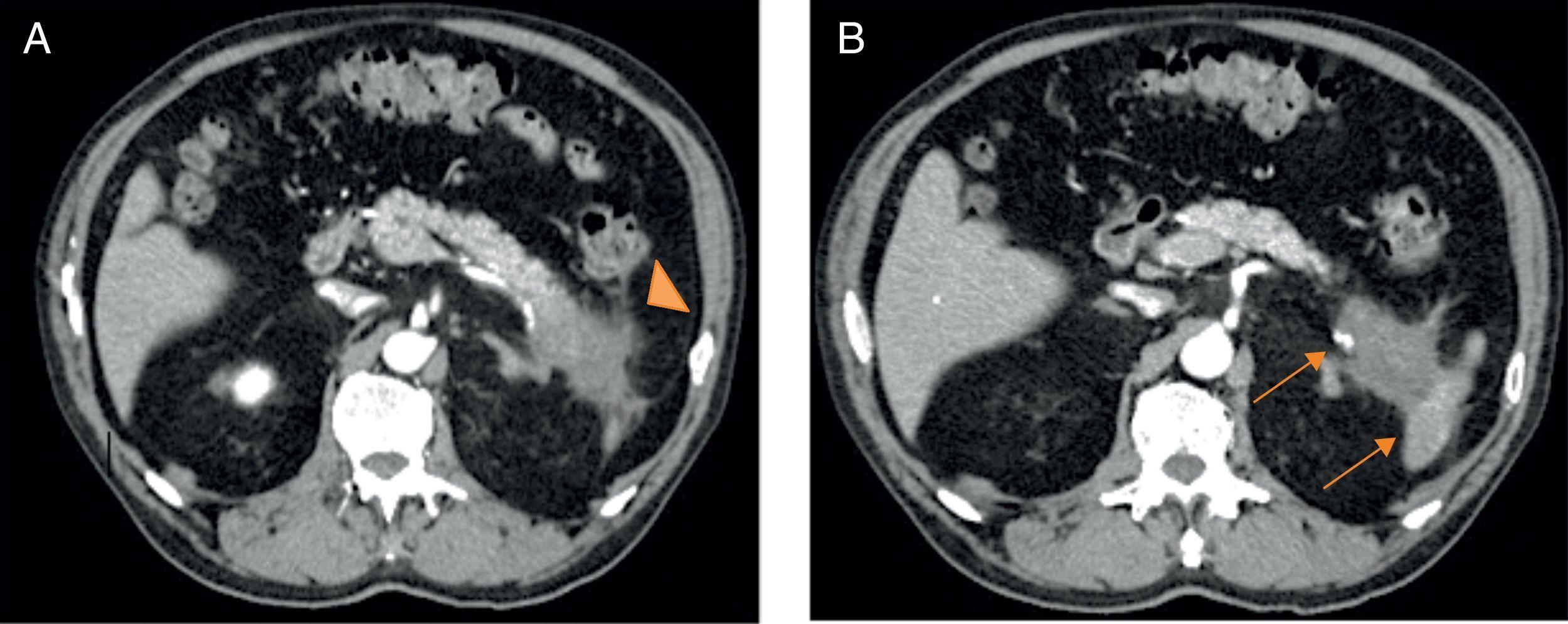 Estadificación mediante tomografía computarizada del carcinoma de ...
