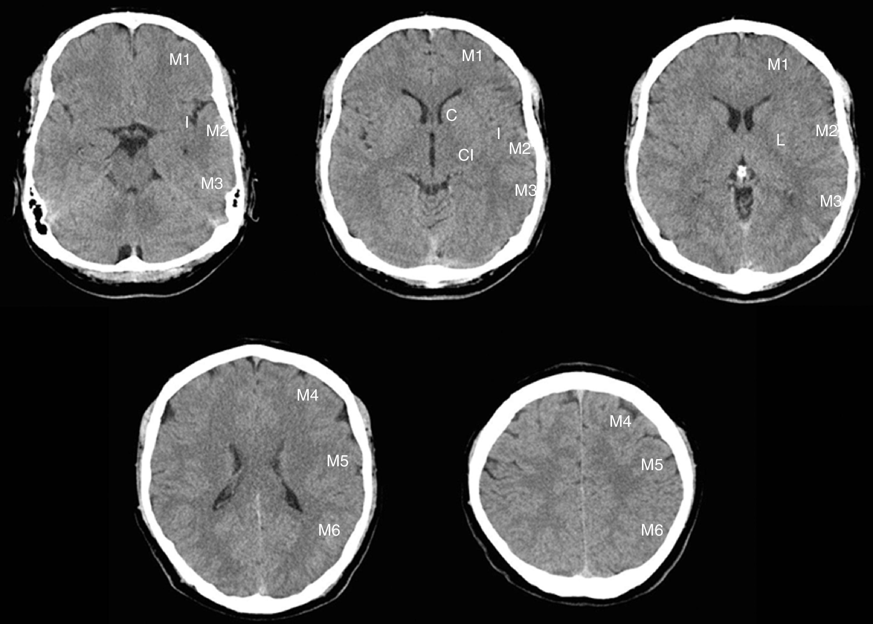 Papel del estudio radiológico multimodal en el código ictus | Radiología