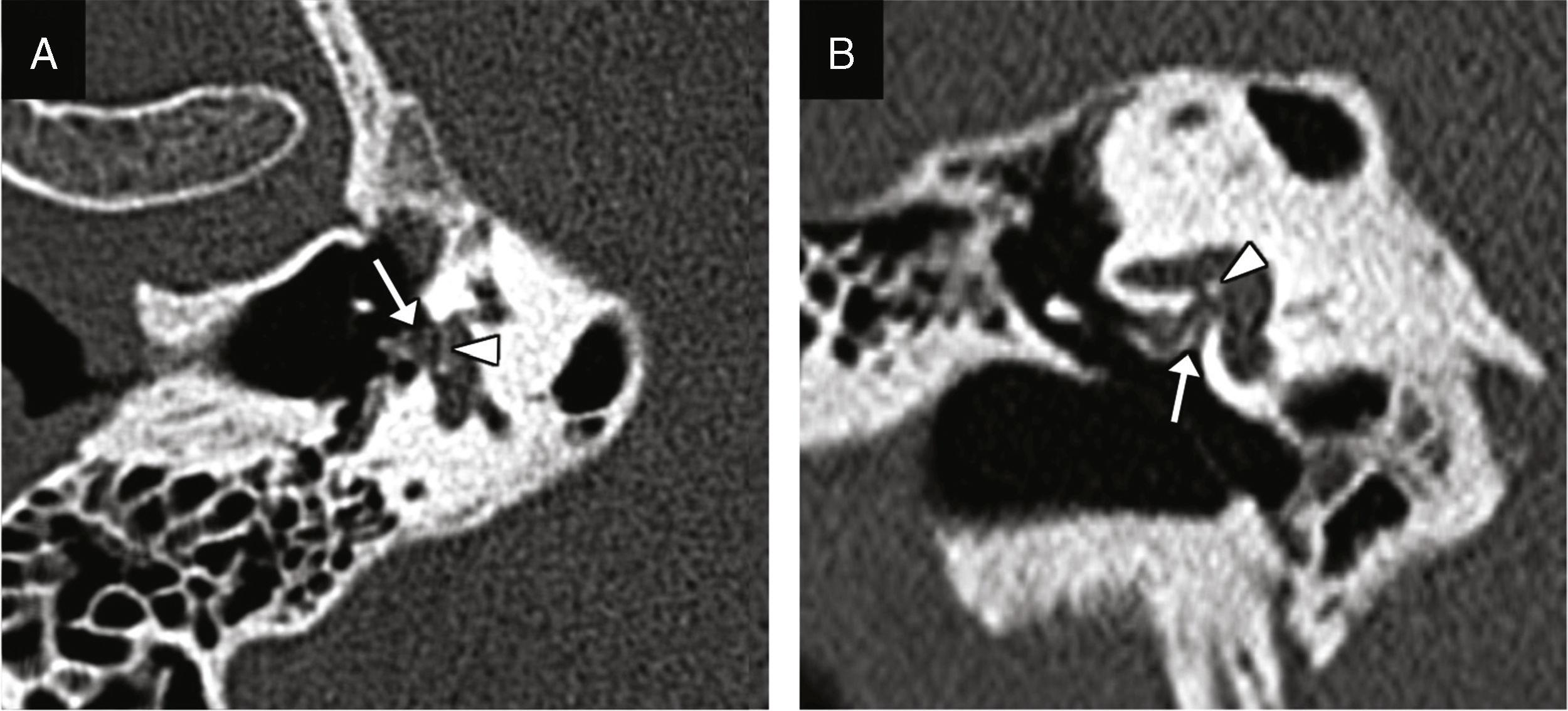Imagen de la hipoacusia postraumática | Radiología