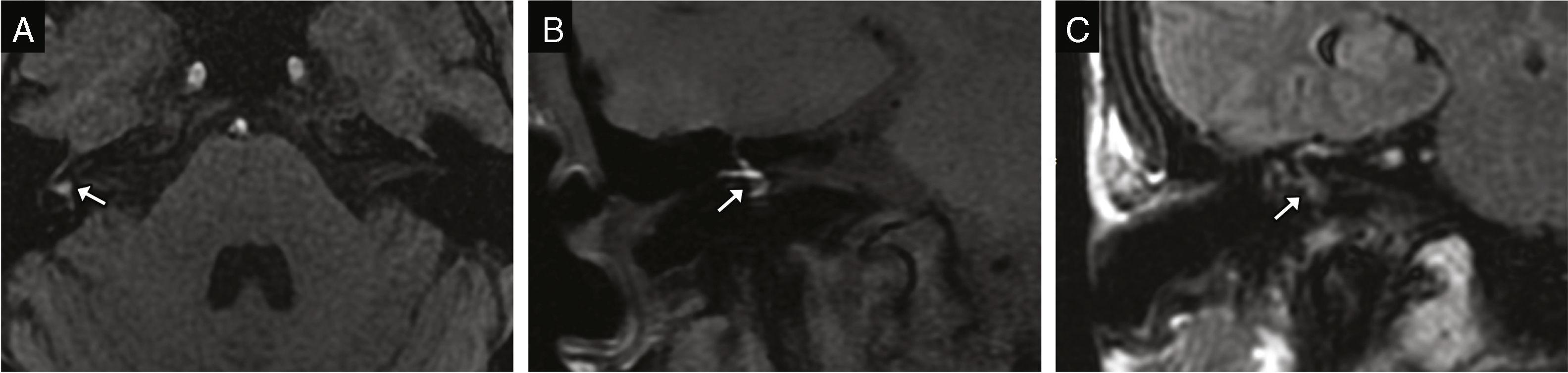 Imagen de la hipoacusia postraumática | Radiología