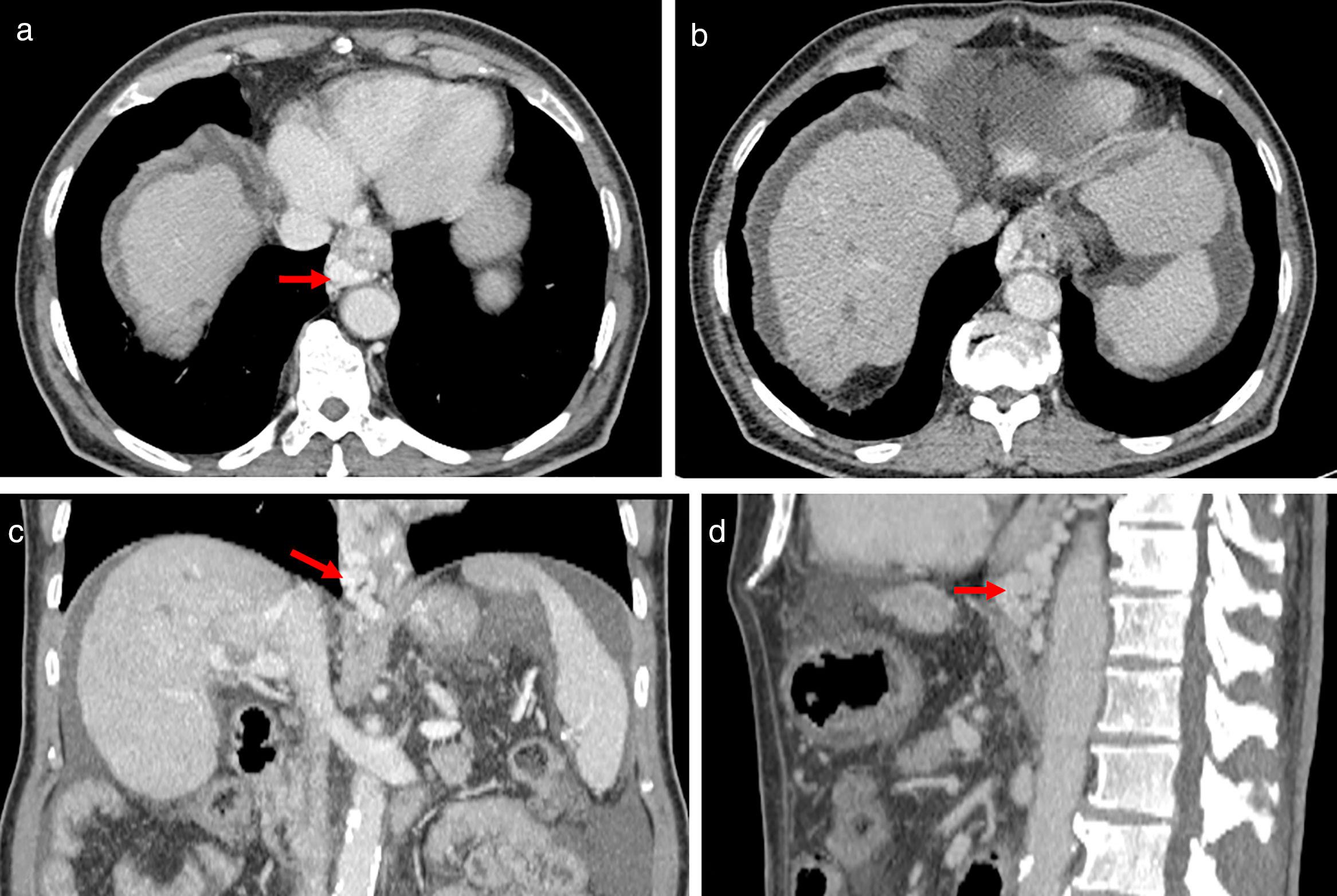 Diagnóstico por imagen de la hipertensión portal | Radiología
