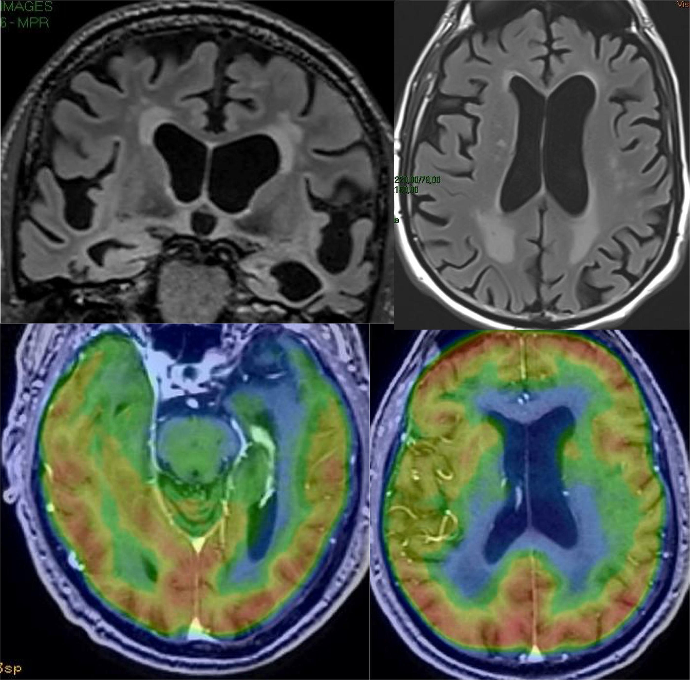 Neuroimagen en demencia. Correlación clínico-radiológica | Radiología