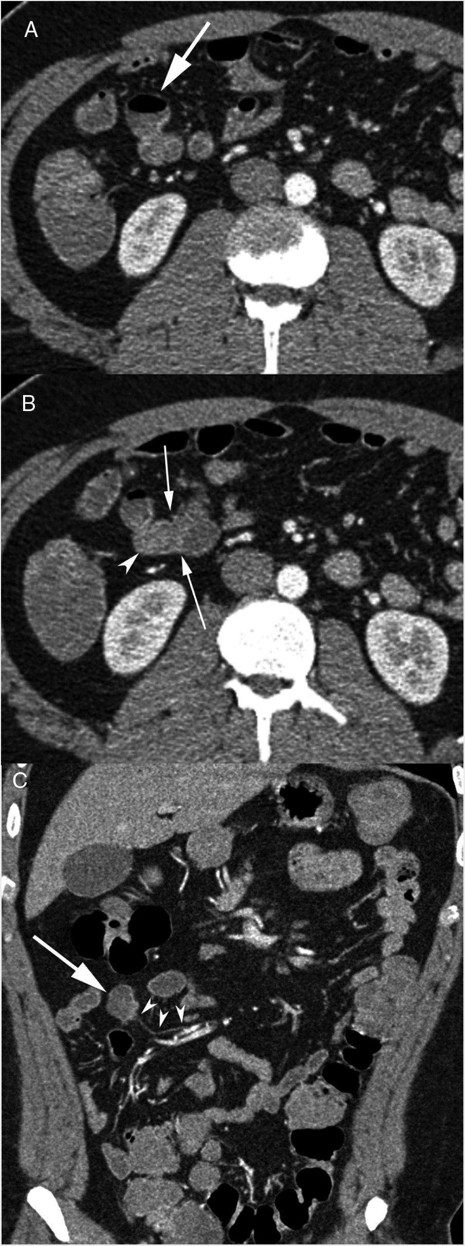 Tomografía computarizada del divertículo de Meckel complicado en ...