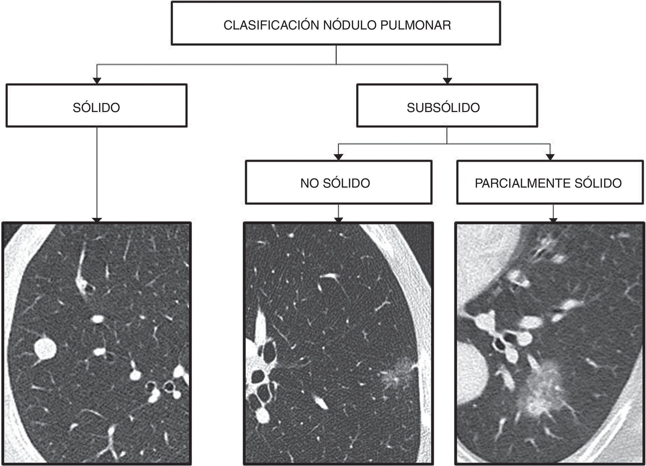 Nódulo pulmonar incidental: caracterización y manejo | Radiología