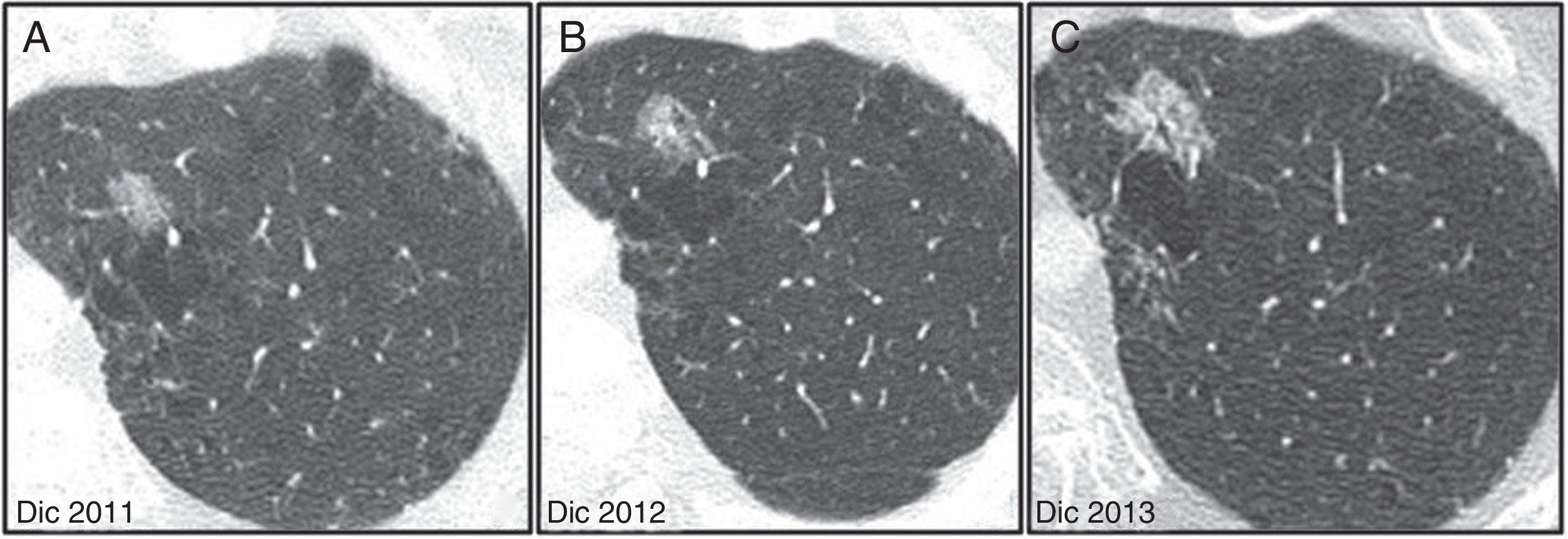 Nódulo pulmonar incidental: caracterización y manejo | Radiología